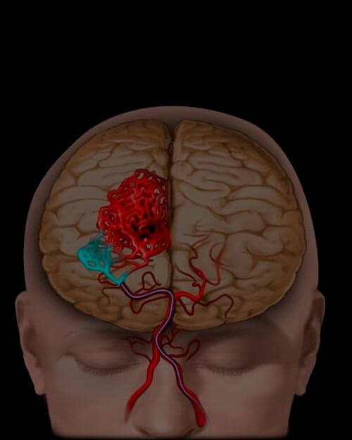 Malformação Arteriovenosa (MAV) - Dr José Alberto