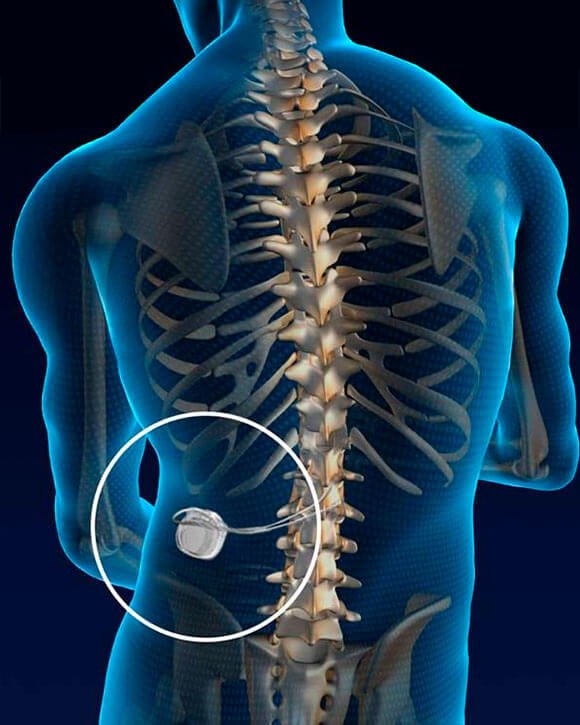 Neuroestimuladores - Dr José Alberto