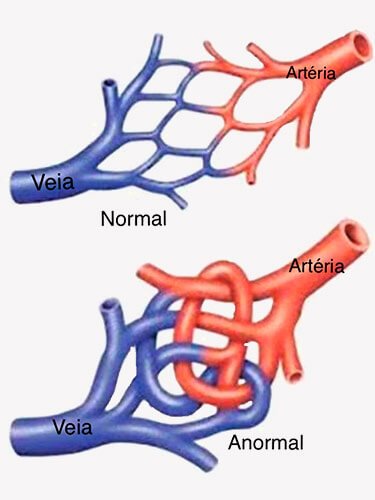 Malformação Arteriovenosa (MAV) - Dr José Alberto
